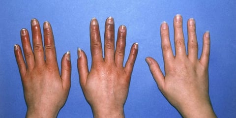 Quantaflo: finally an effective test that diagnoses Peripheral Artery ...